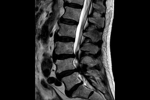 Traiter efficacement la sténose du canal rachidien – Vos spécialistes ...