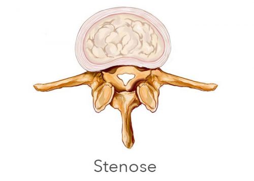 Traiter efficacement la sténose du canal rachidien – Vos spécialistes ...